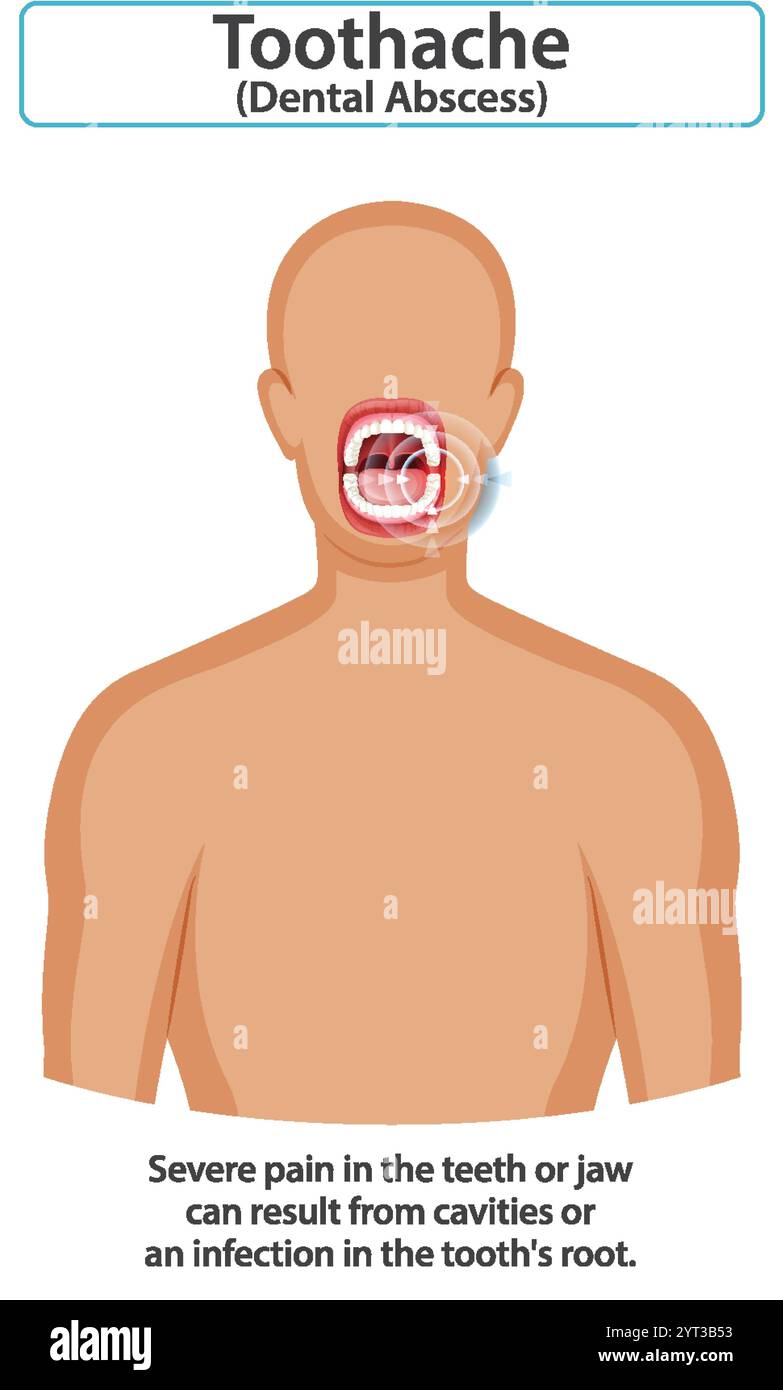 Illustration of toothache symptoms and dental abscess Stock Vector ...