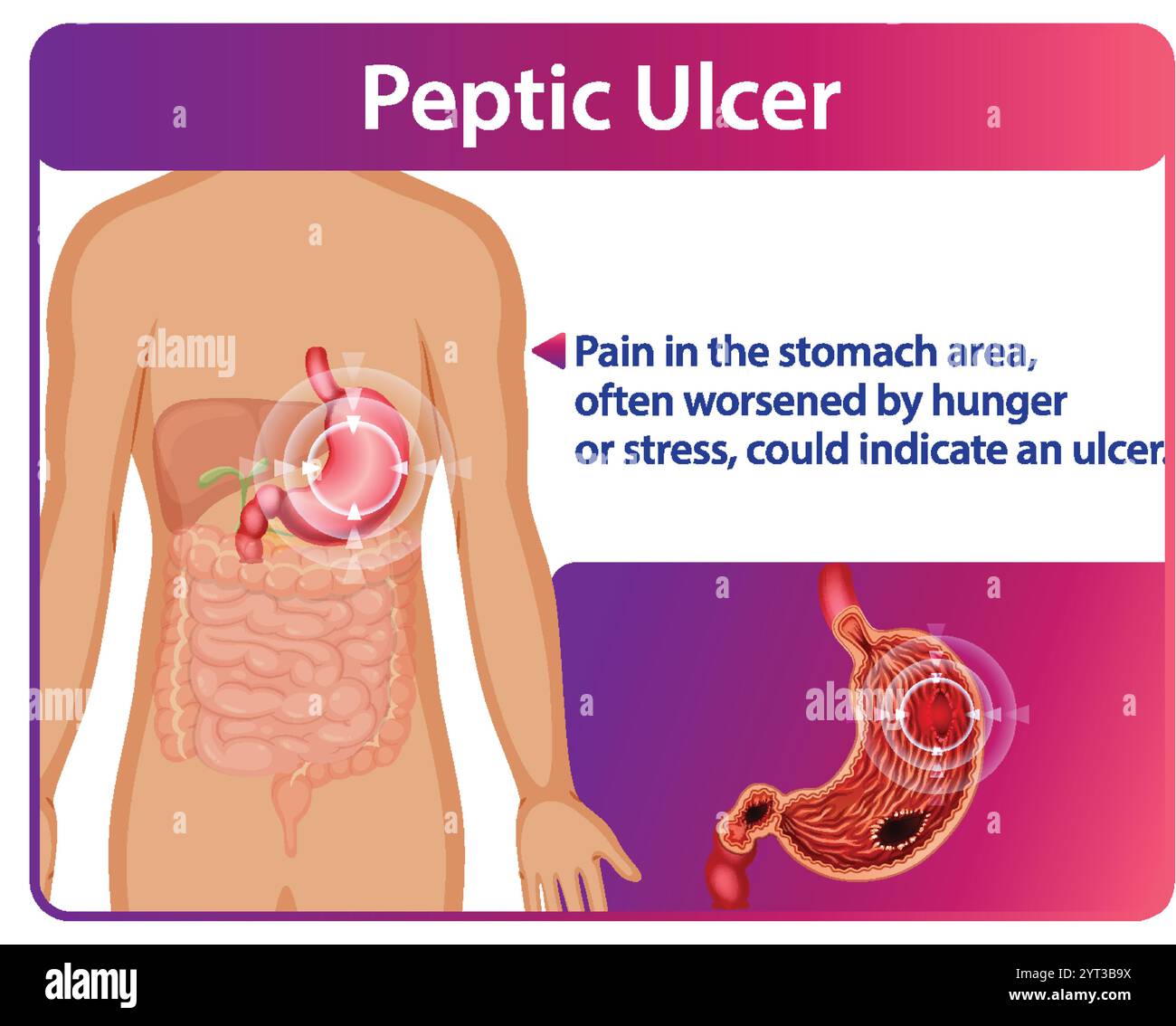 Illustration of peptic ulcer symptoms and stomach anatomy Stock Vector Image & Art - Alamy
