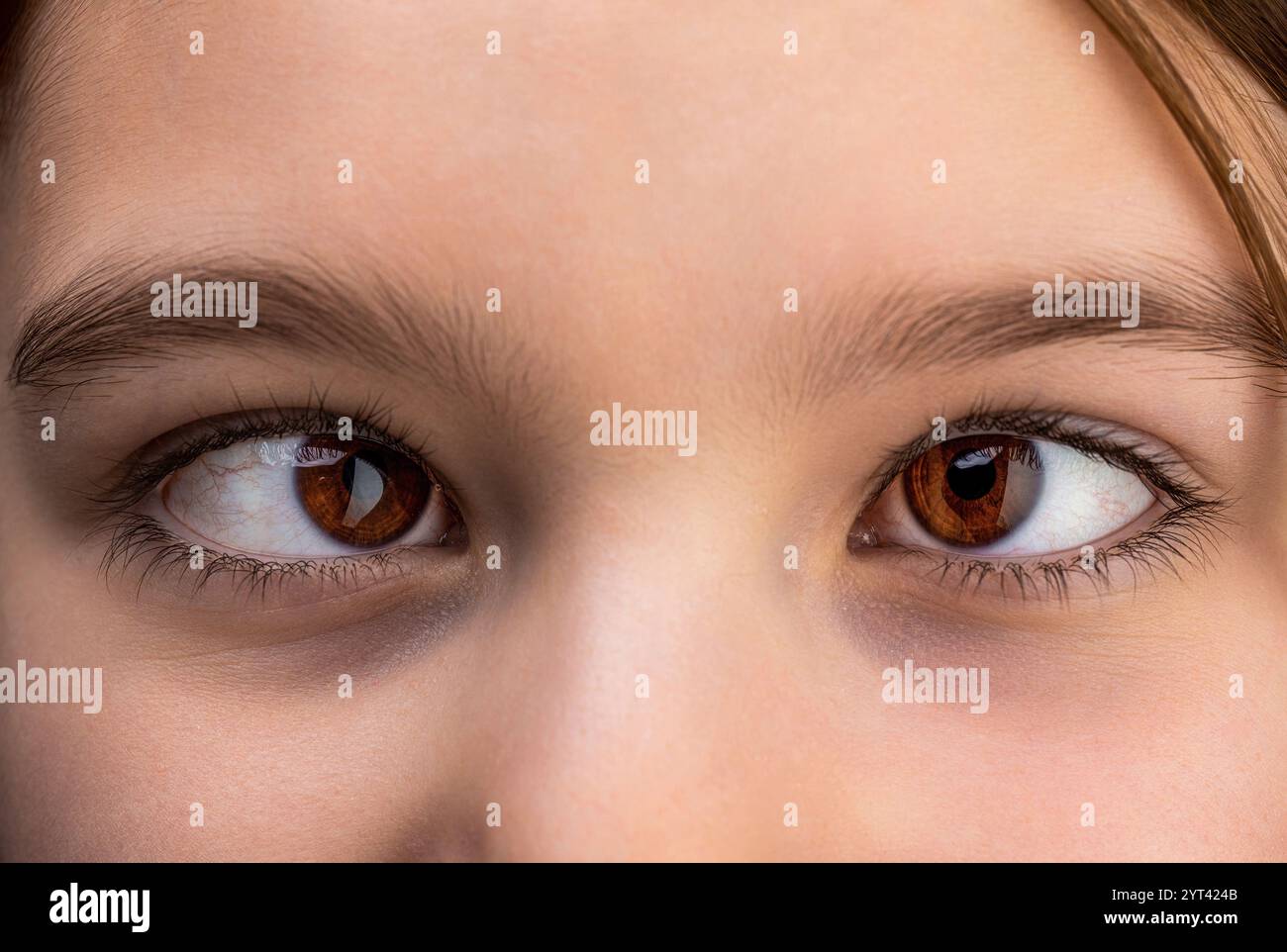 Strabismus, treatment ophthalmic diseases. Female eyes with strabismus ...