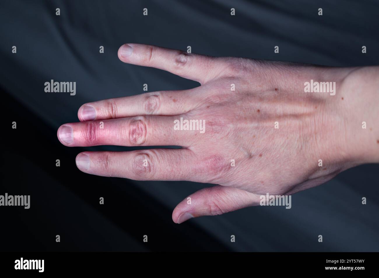 Mallet finger healing after splint removal from middle finger following ...