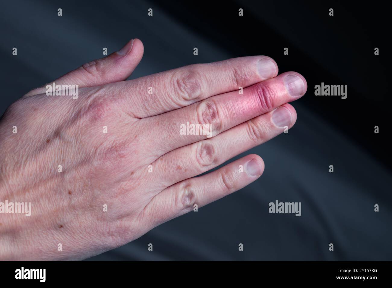 Mallet finger healing after splint removal from middle finger following ...