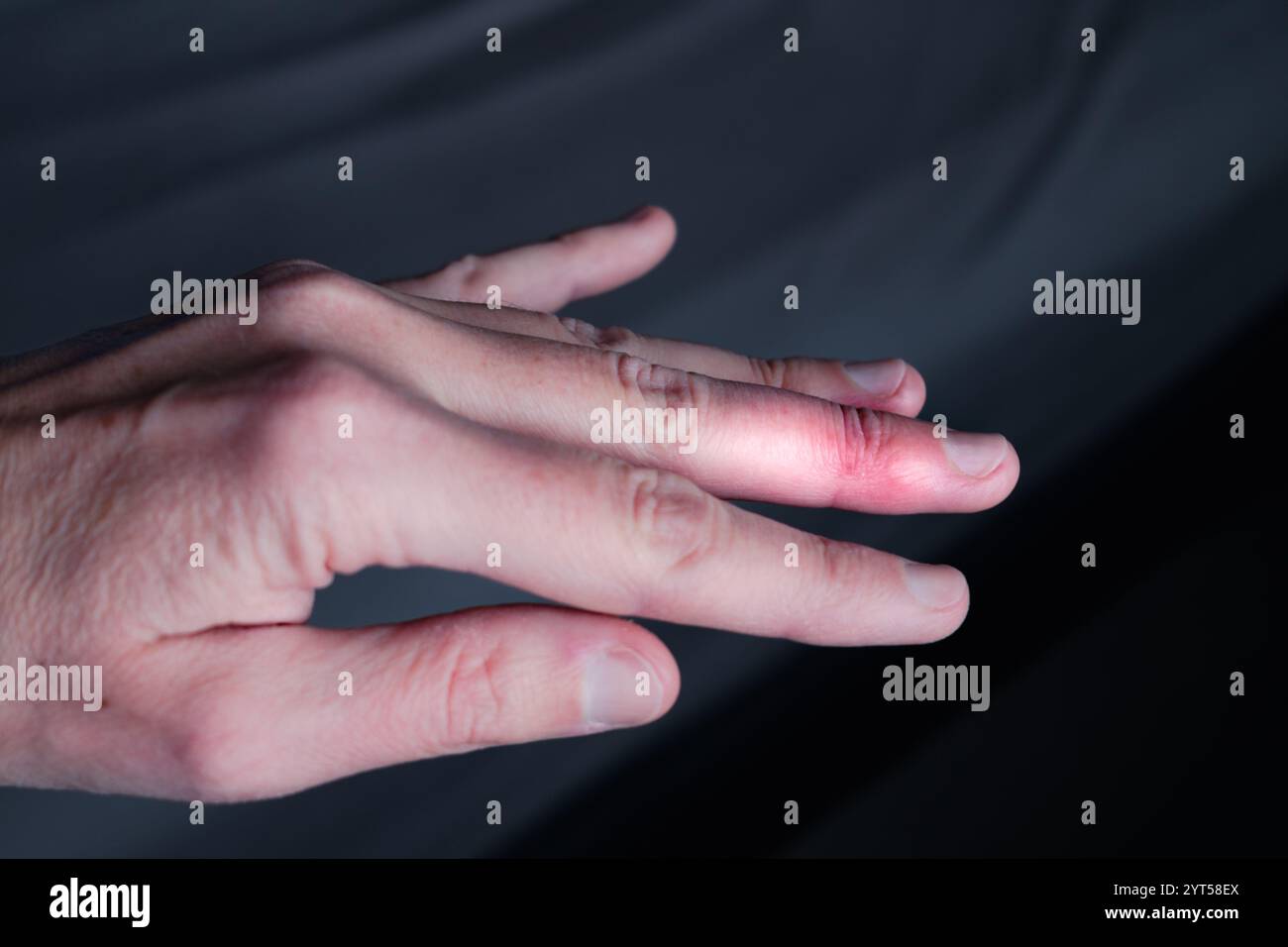 Mallet finger healing after splint removal from middle finger following ...