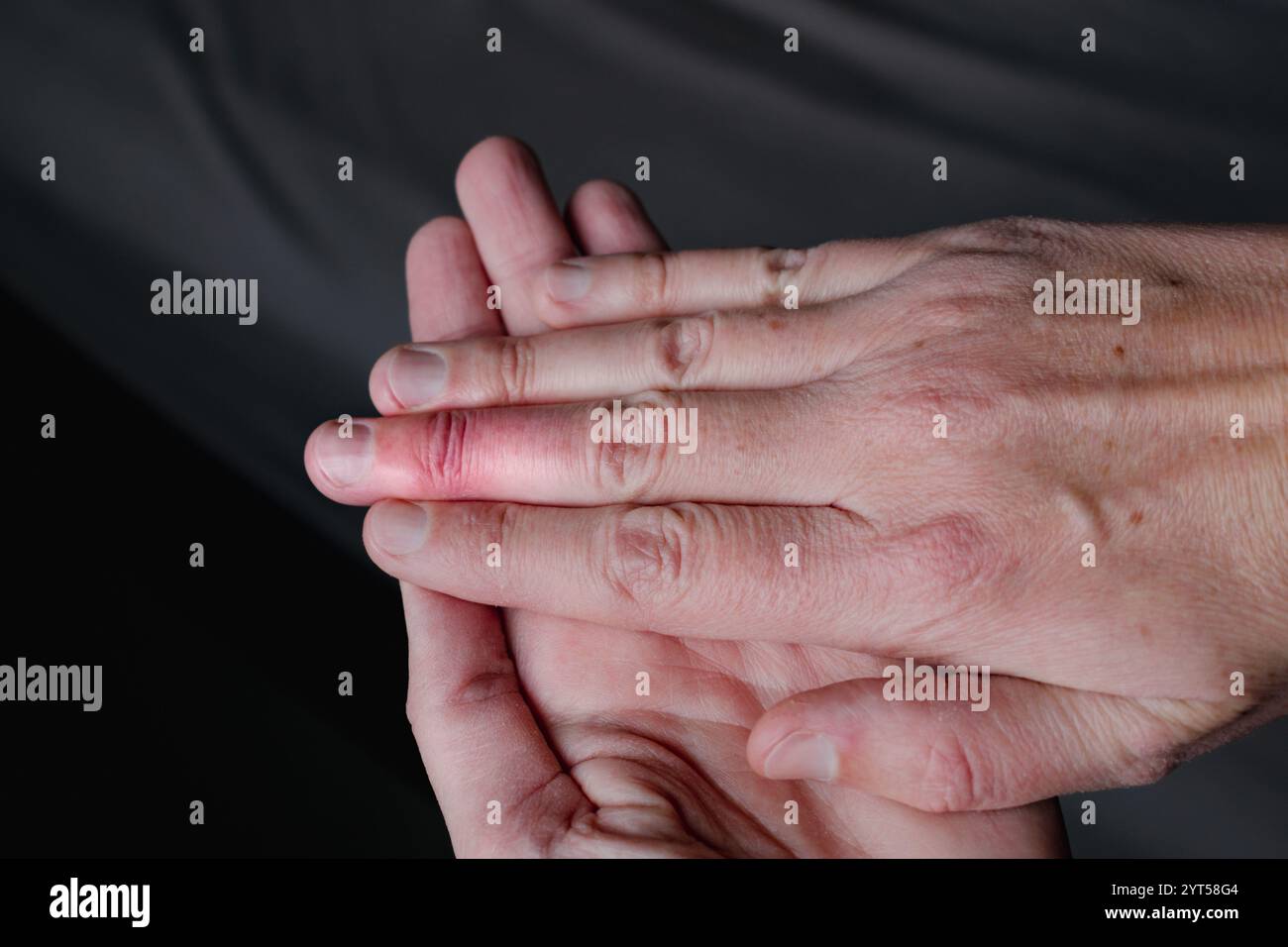 Mallet finger healing after splint removal from middle finger following ...