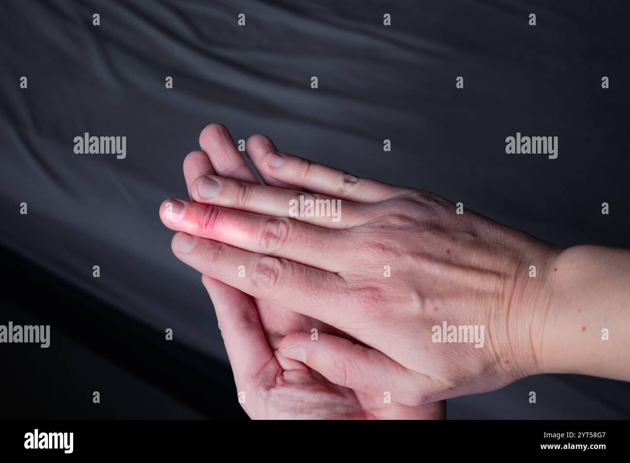 Mallet finger healing after splint removal from middle finger following ...