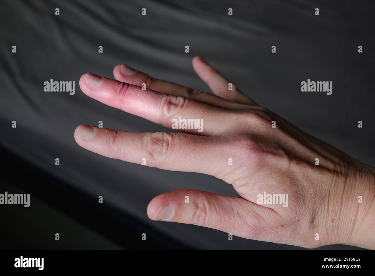 Mallet finger healing after splint removal from middle finger following ...