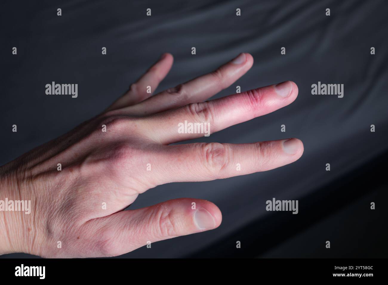 Mallet finger healing after splint removal from middle finger following ...