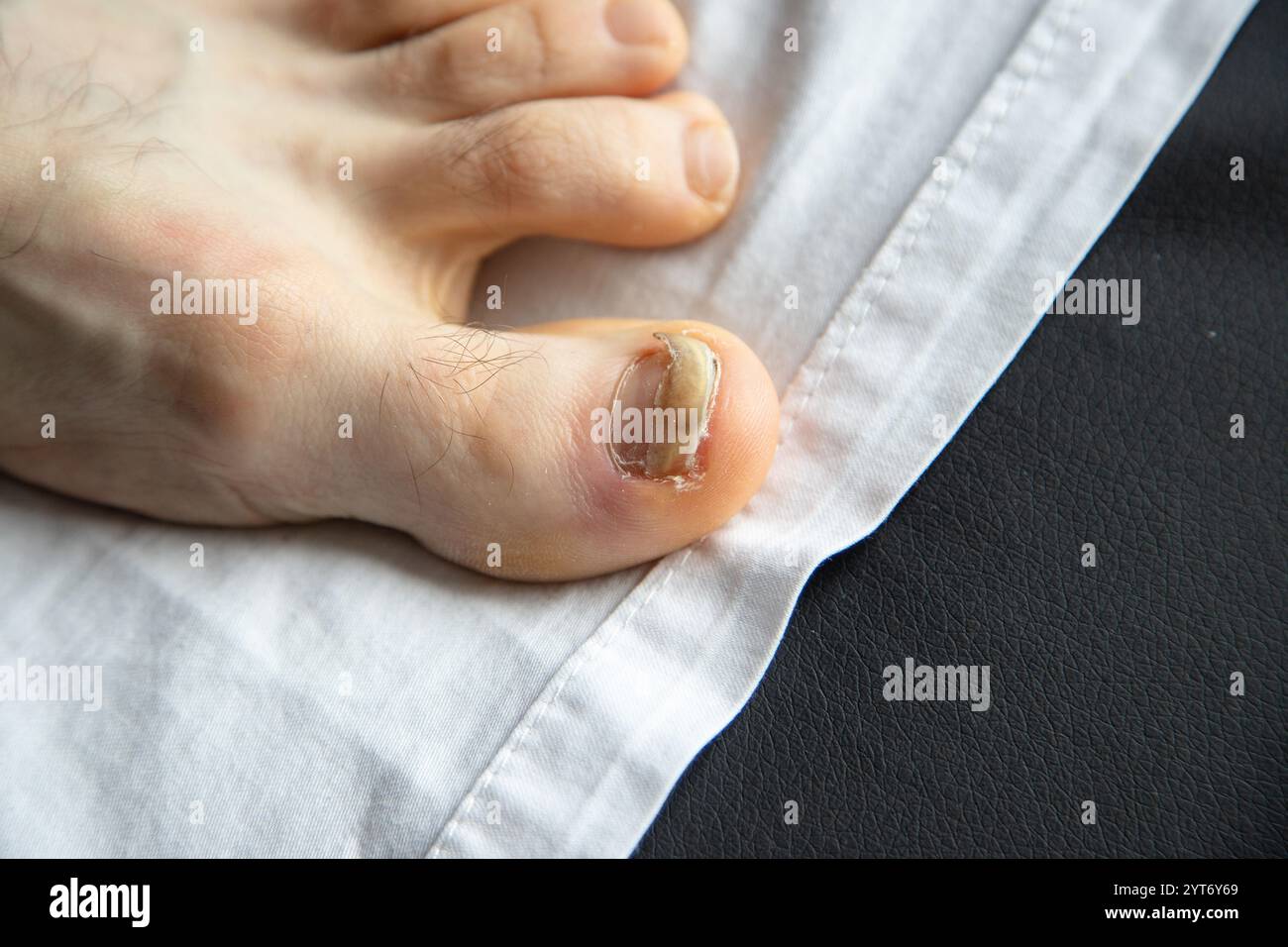 A close-up of a damaged toenail after trauma, bruise, photographed ...
