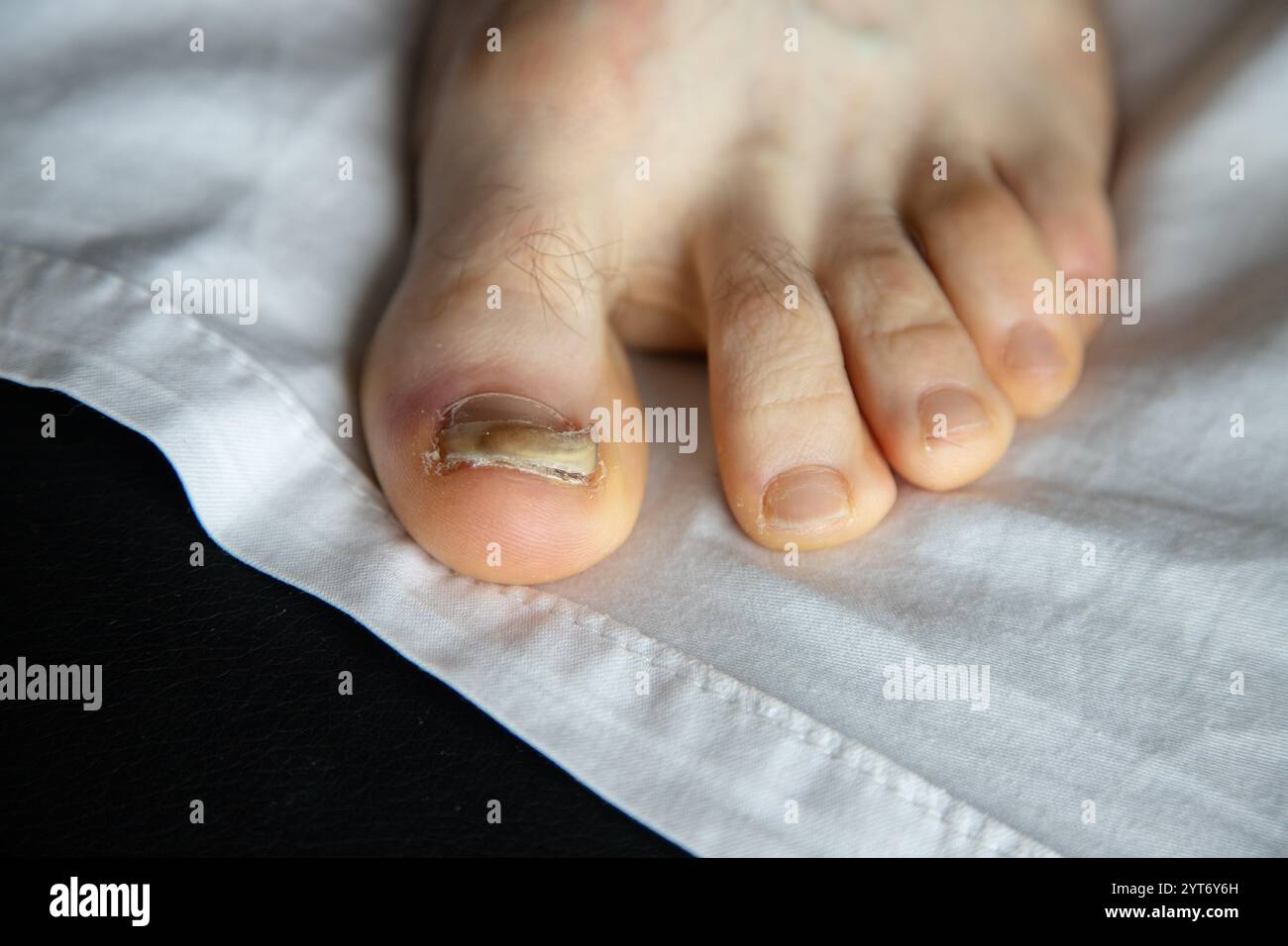 A close-up of a damaged toenail after trauma, bruise, photographed ...