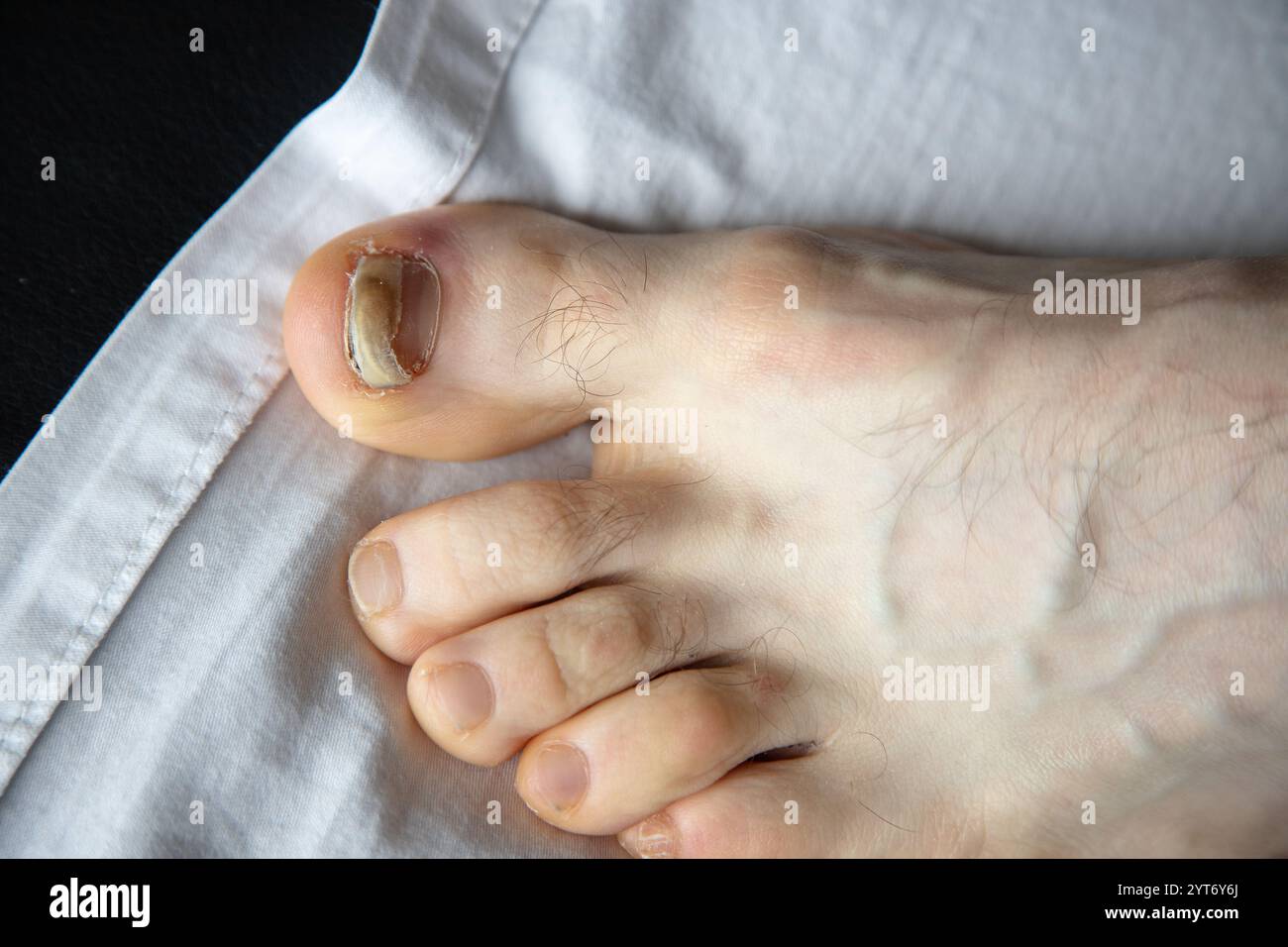 A close-up of a damaged toenail after trauma, bruise, photographed ...