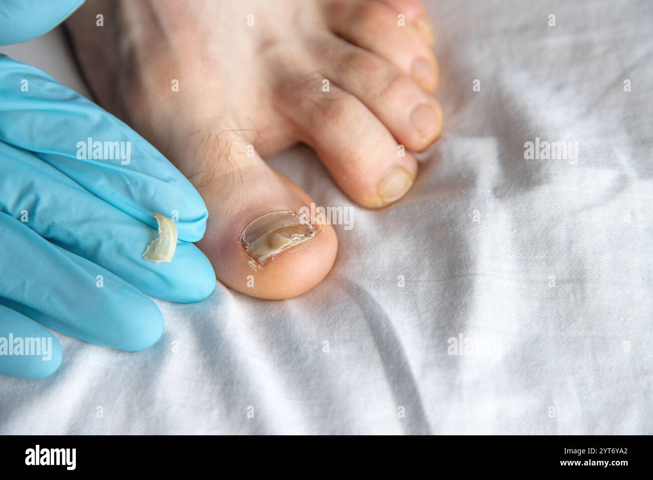 Close-up of a damaged toenail being examined by gloved hands indoors ...