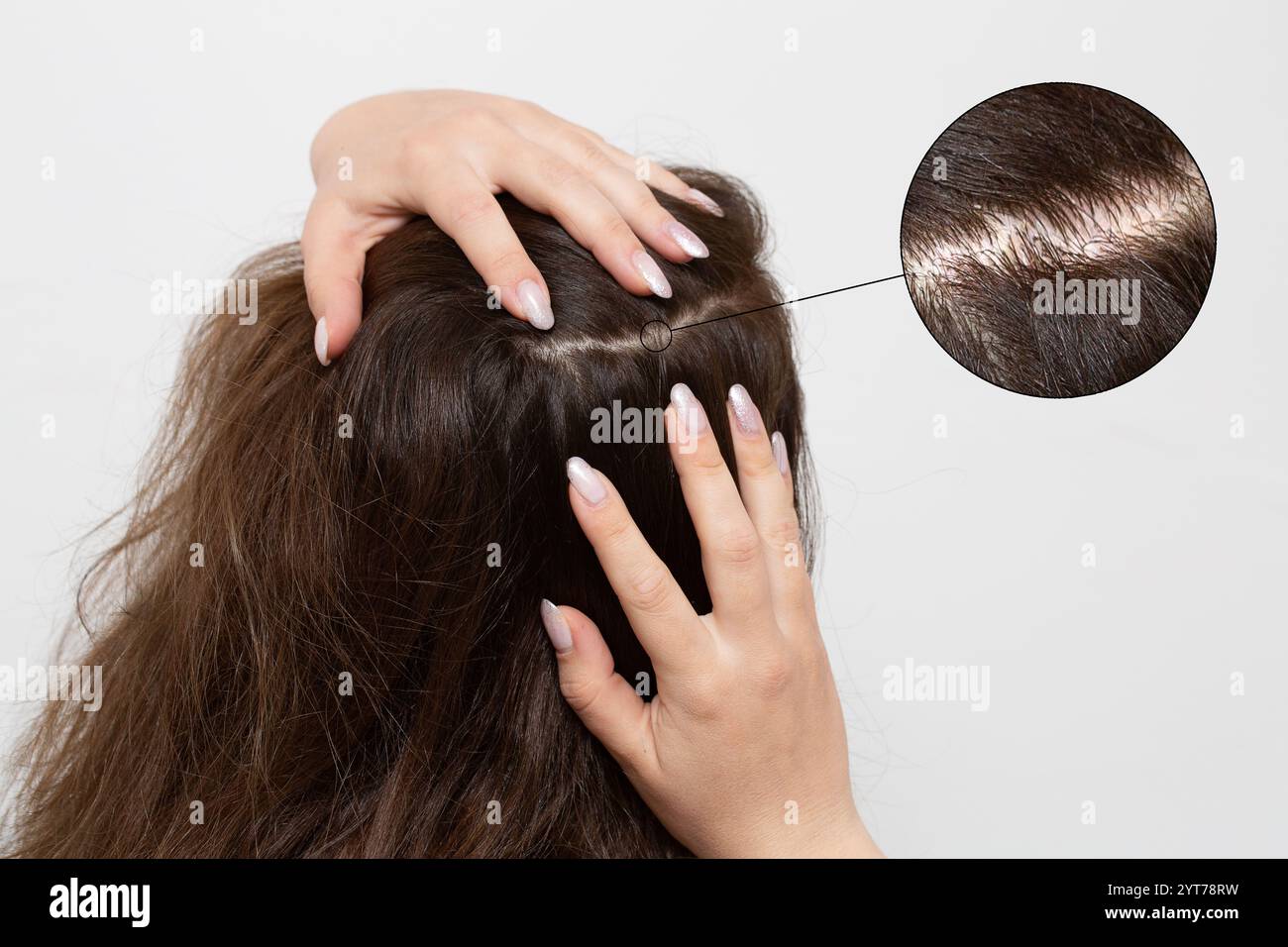 Close-up of woman examining her scalp, revealing dandruff flakes and ...
