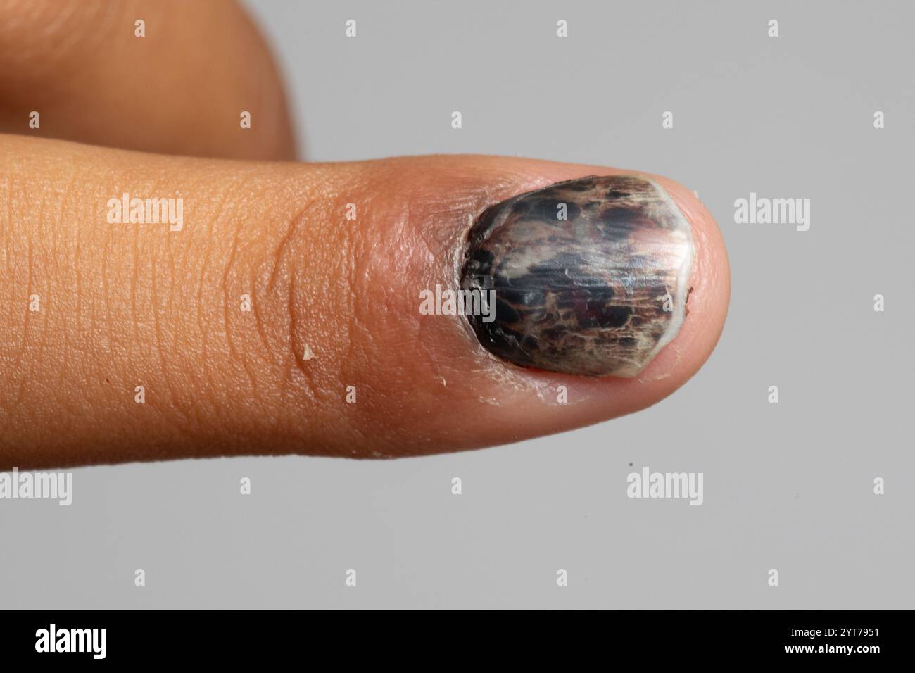 Damaged black toenail with fungal infection, requiring medical ...