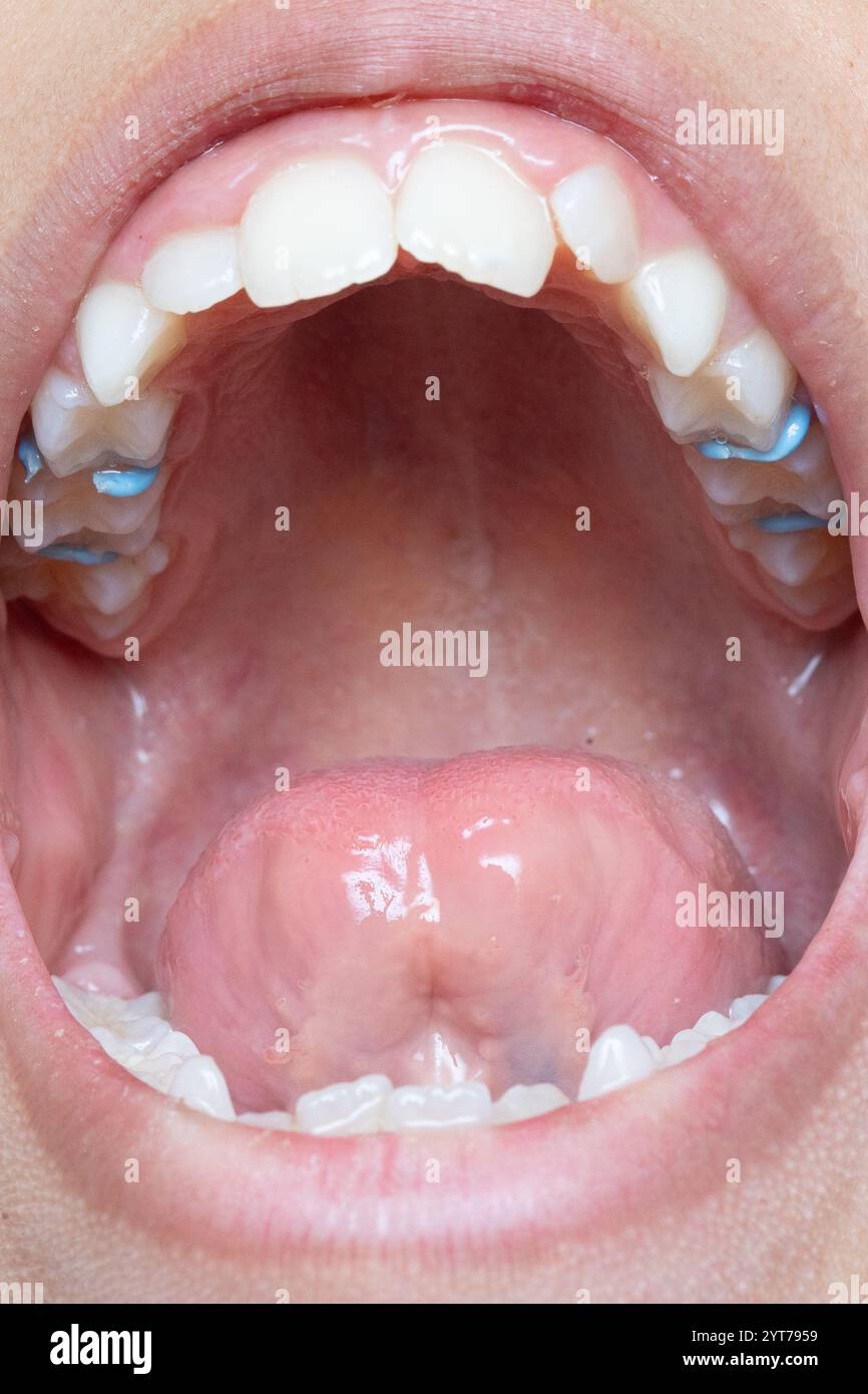 Inside view of mouth showing orthodontic appliance attached to teeth ...