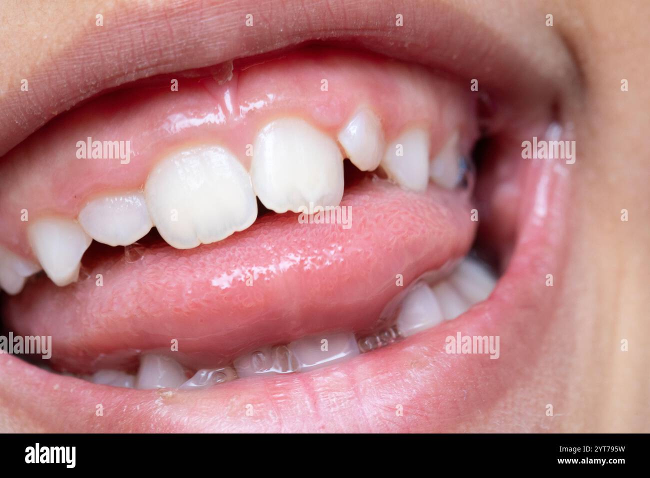 Open mouth showing tongue and teeth, indicating potential dental health ...