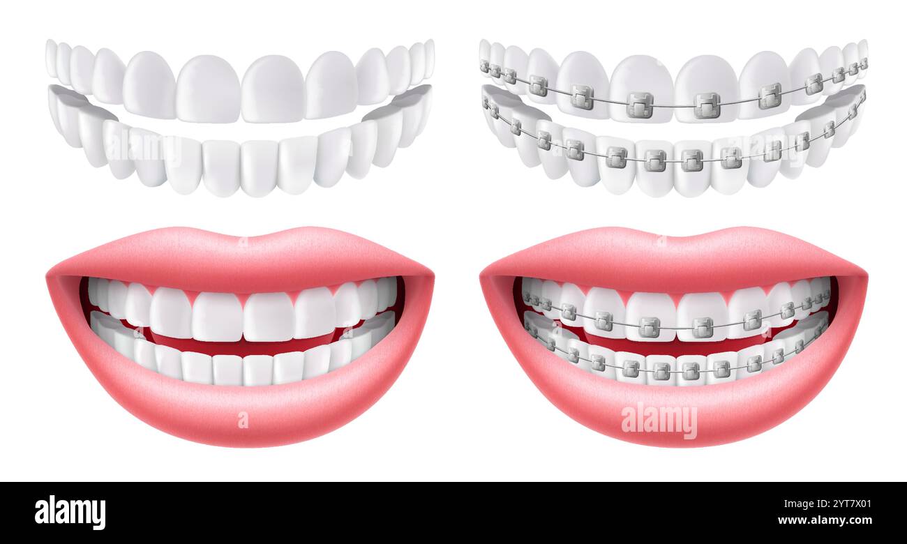 Teeth with or without braces. Arch braces without teeth. Orthodontic ...