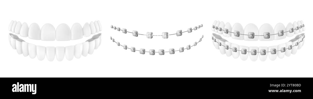 Teeth with or without braces isolated on white background. Arch braces ...