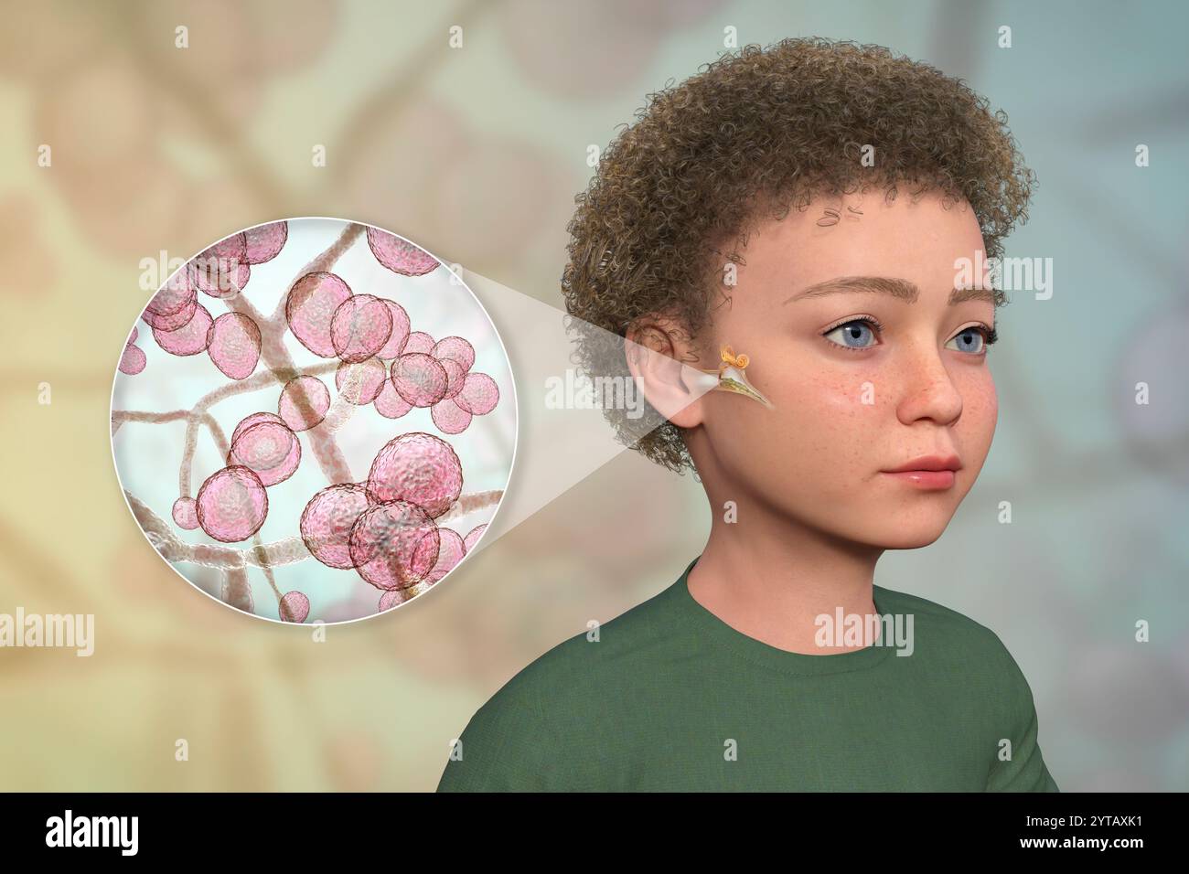 Computer illustration of a child with transparent skin depicting fungal ...