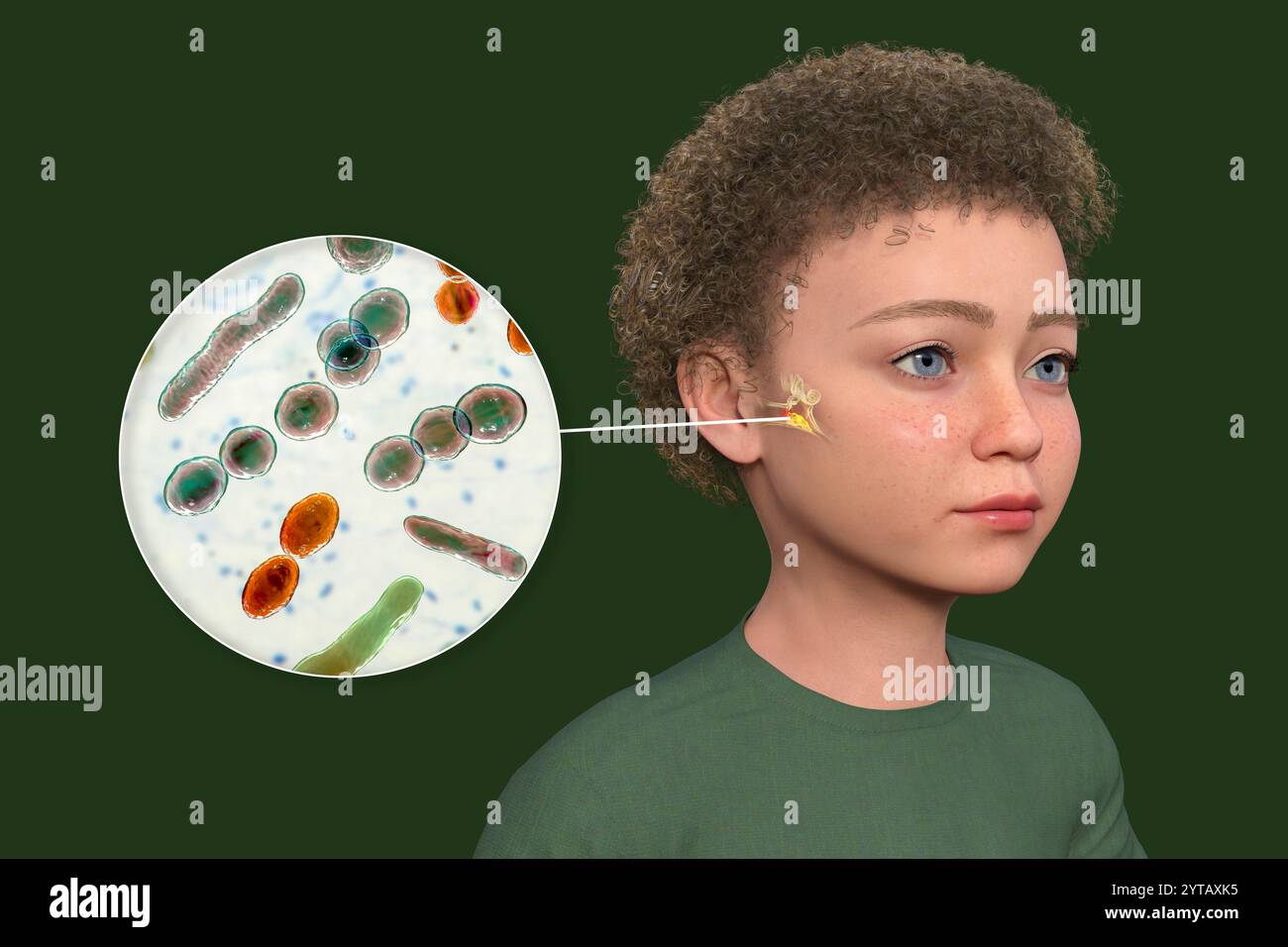 Computer illustration of a child with transparent skin revealing otitis ...