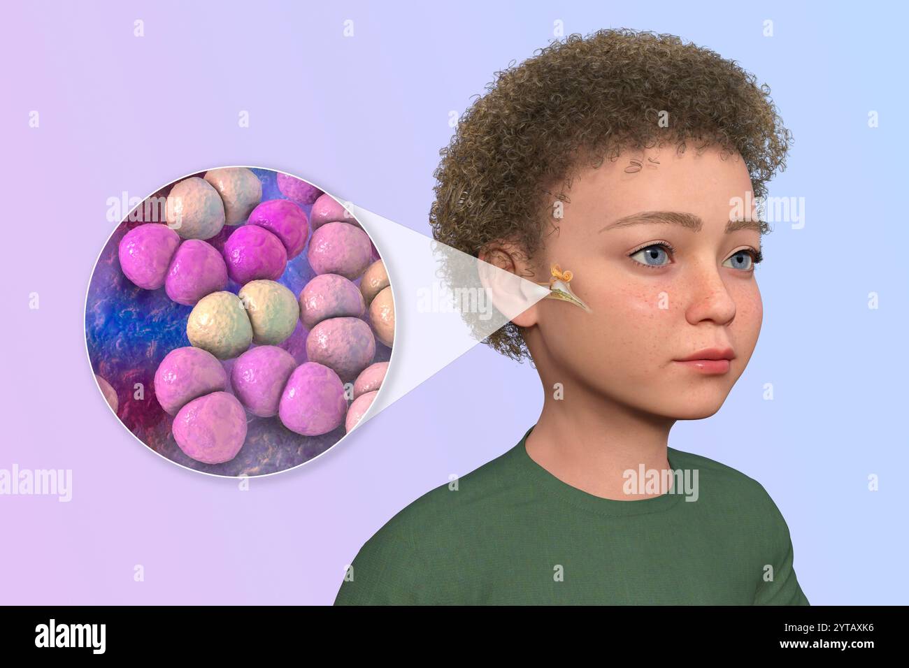 Computer illustration of a child with transparent skin revealing otitis ...