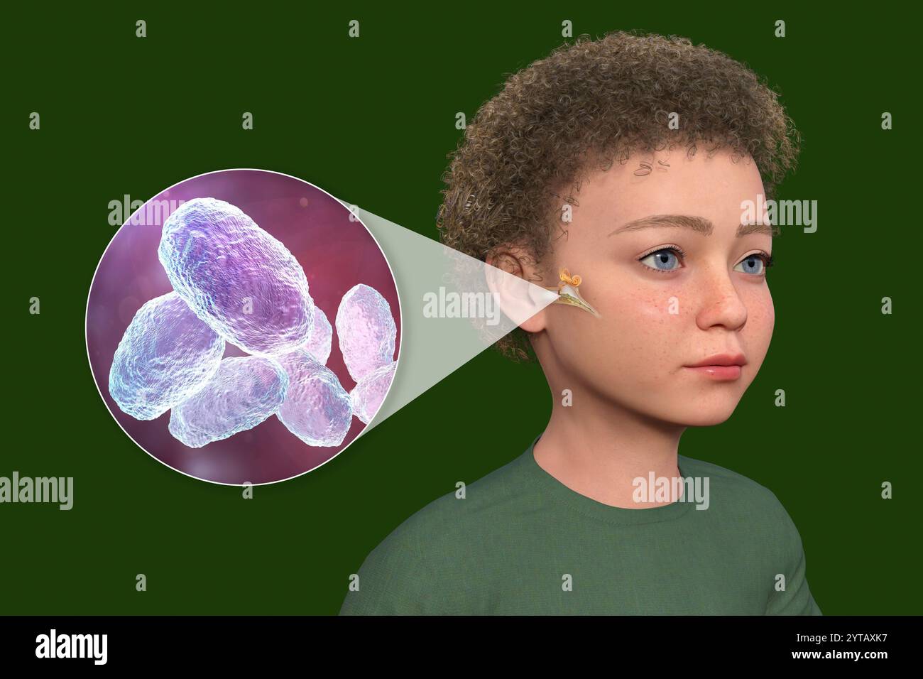 Computer illustration of a child with transparent skin revealing otitis ...
