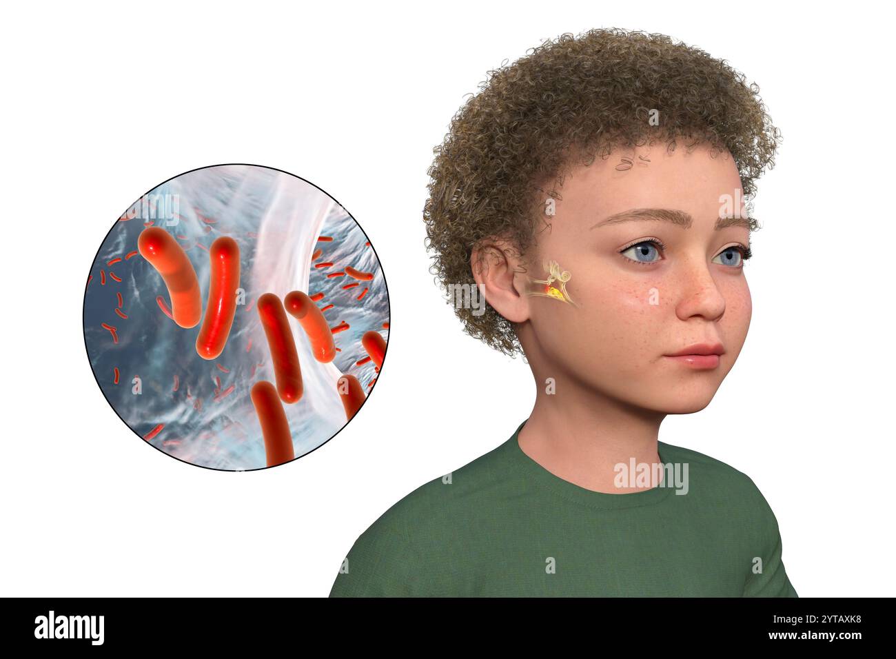 Computer illustration of a child with transparent skin revealing otitis ...