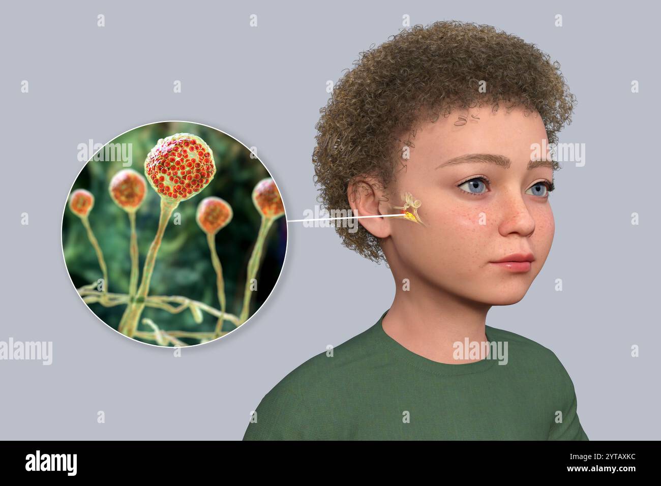 Computer illustration of a child with transparent skin showing fungal ...