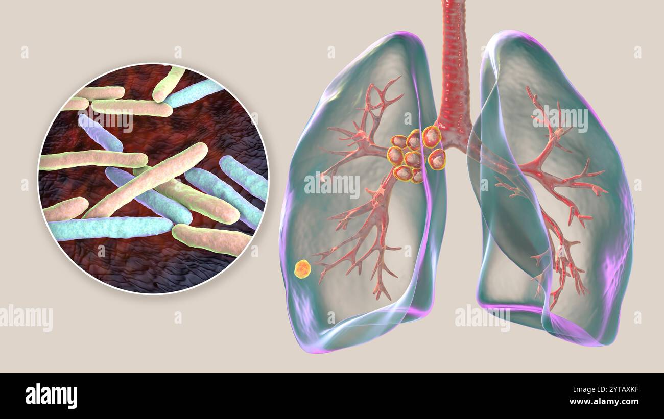 Primary lung tuberculosis with the Ranke complex. Computer illustration ...