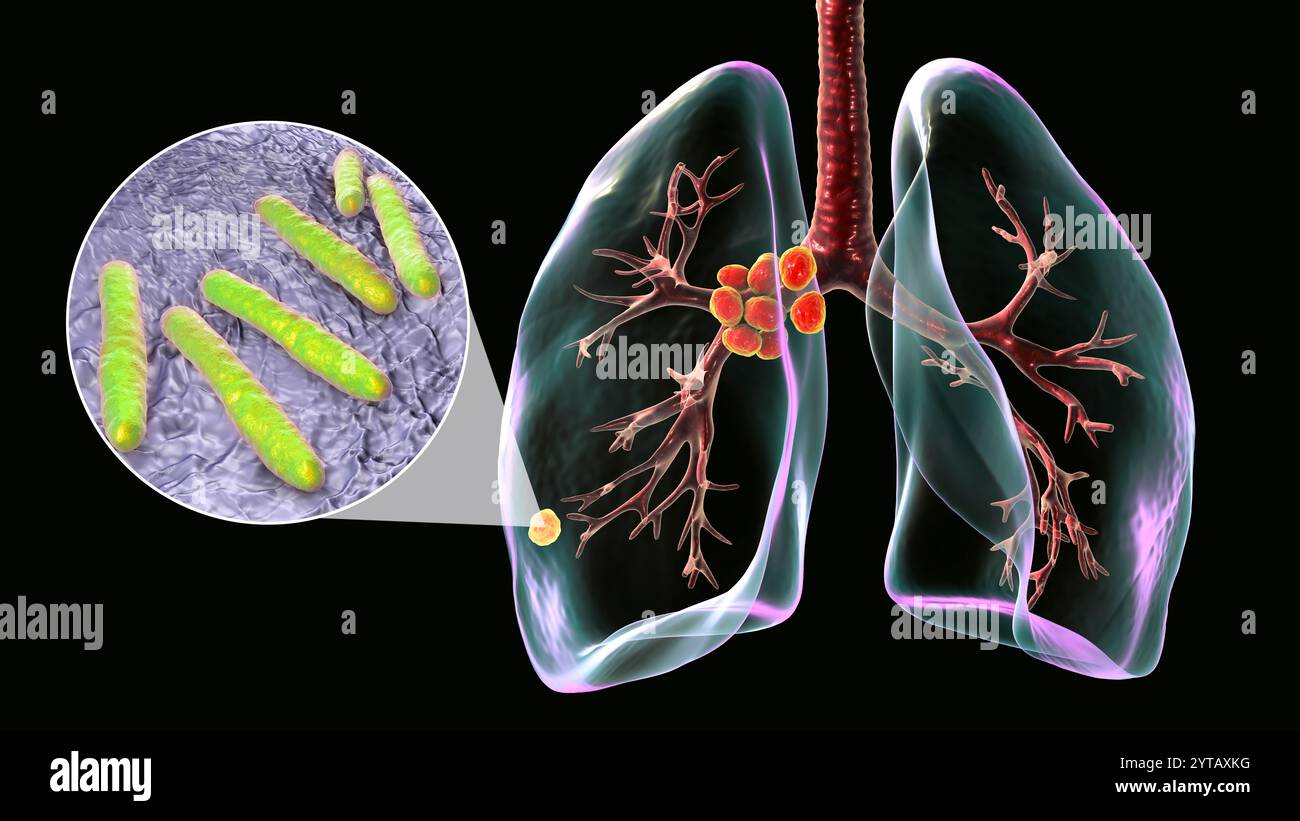 Primary lung tuberculosis. Computer illustration featuring the Ghon complex and mediastinal ...
