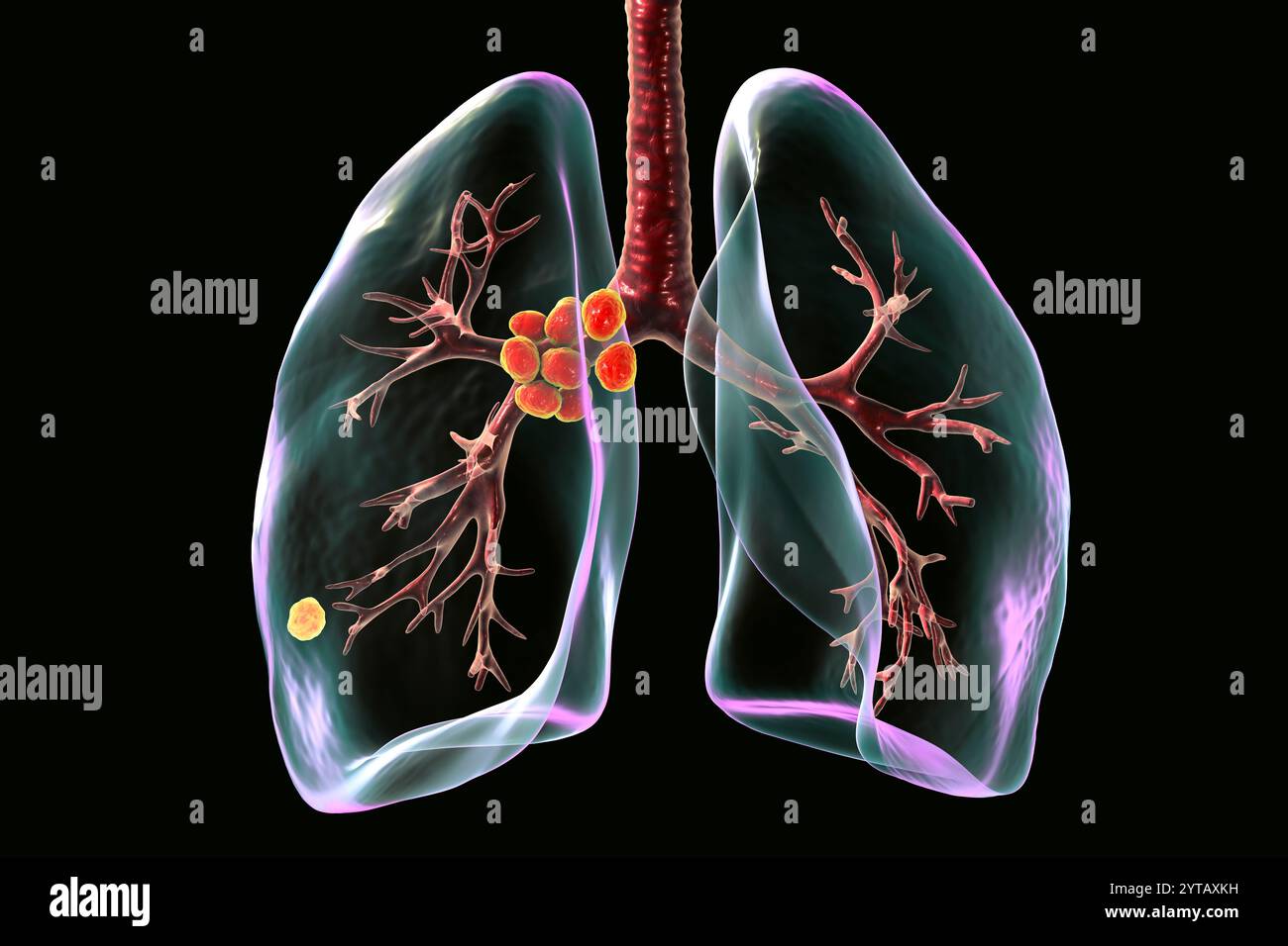 Primary lung tuberculosis. Computer illustration featuring the Ghon ...