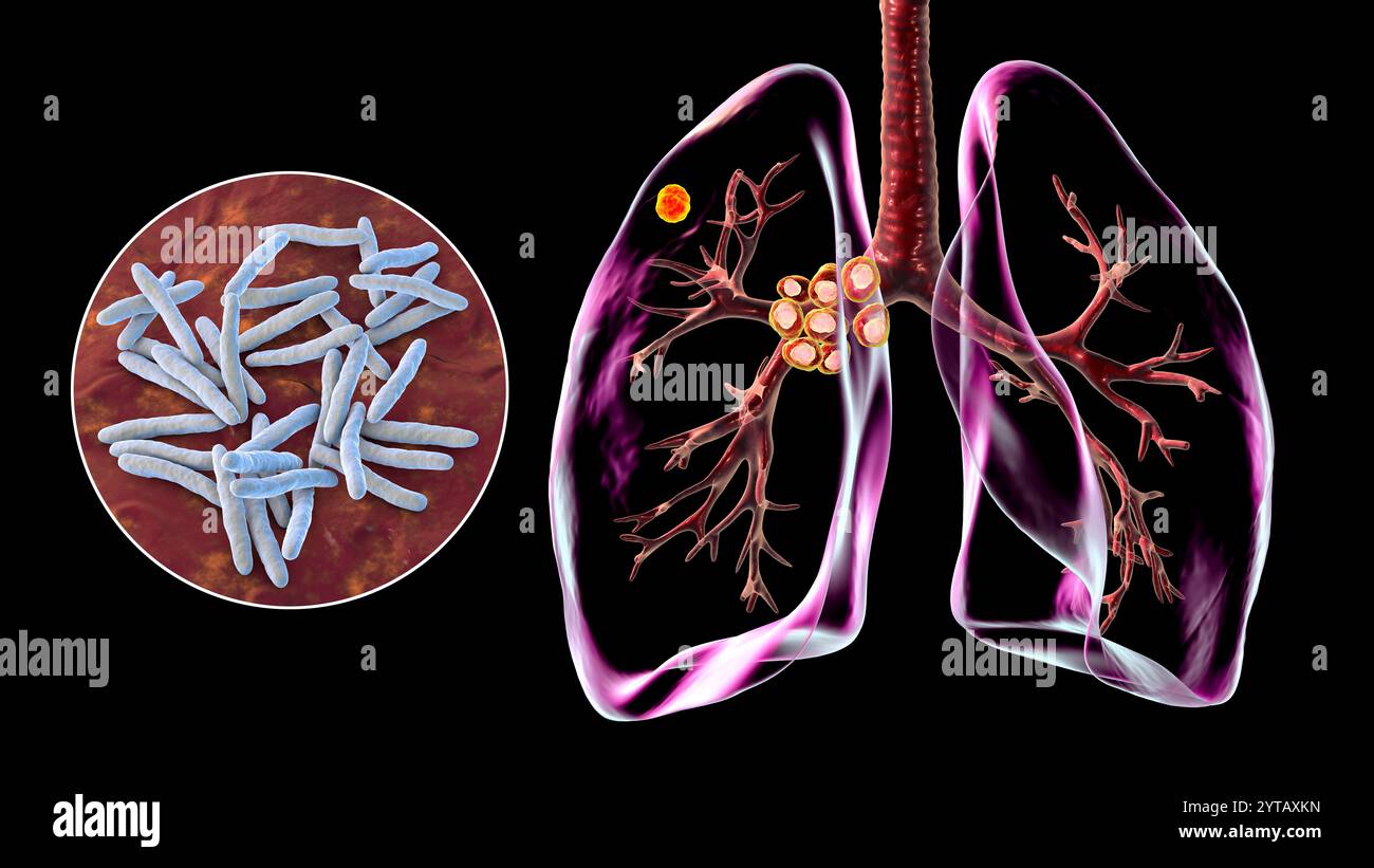 Primary lung tuberculosis with the Ranke complex. Computer illustration ...
