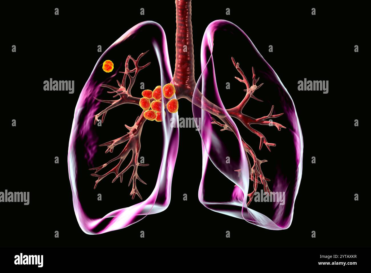 Primary lung tuberculosis. Computer illustration featuring the Ghon ...