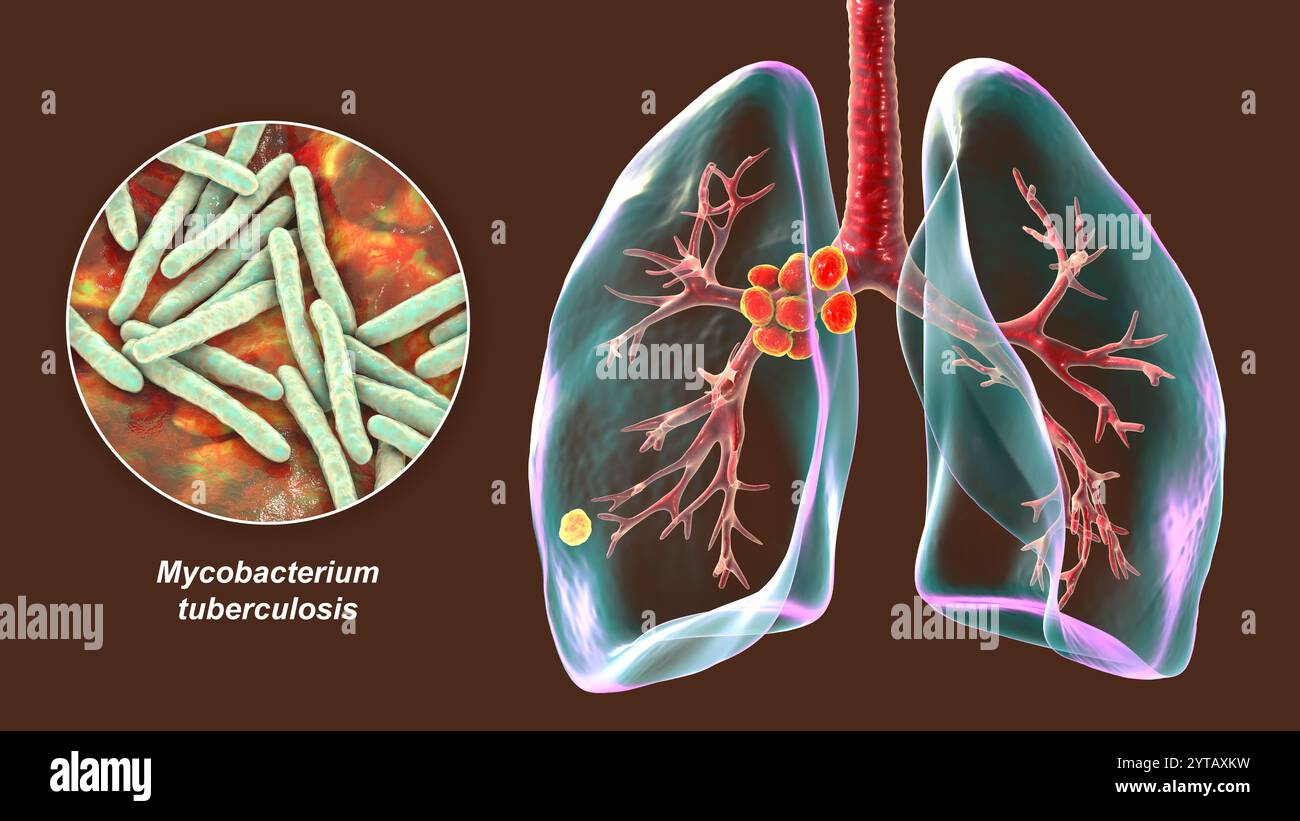Primary lung tuberculosis. Computer illustration featuring the Ghon ...
