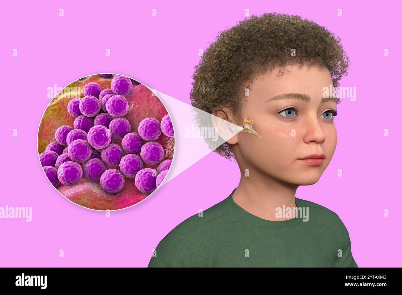 Computer illustration of a child with transparent skin revealing otitis ...