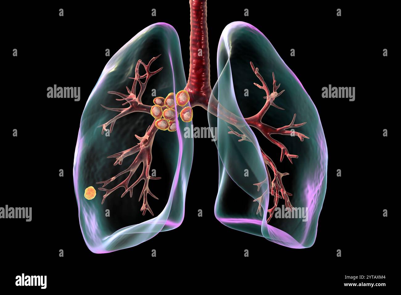 Primary lung tuberculosis with the Ranke complex. Computer illustration ...