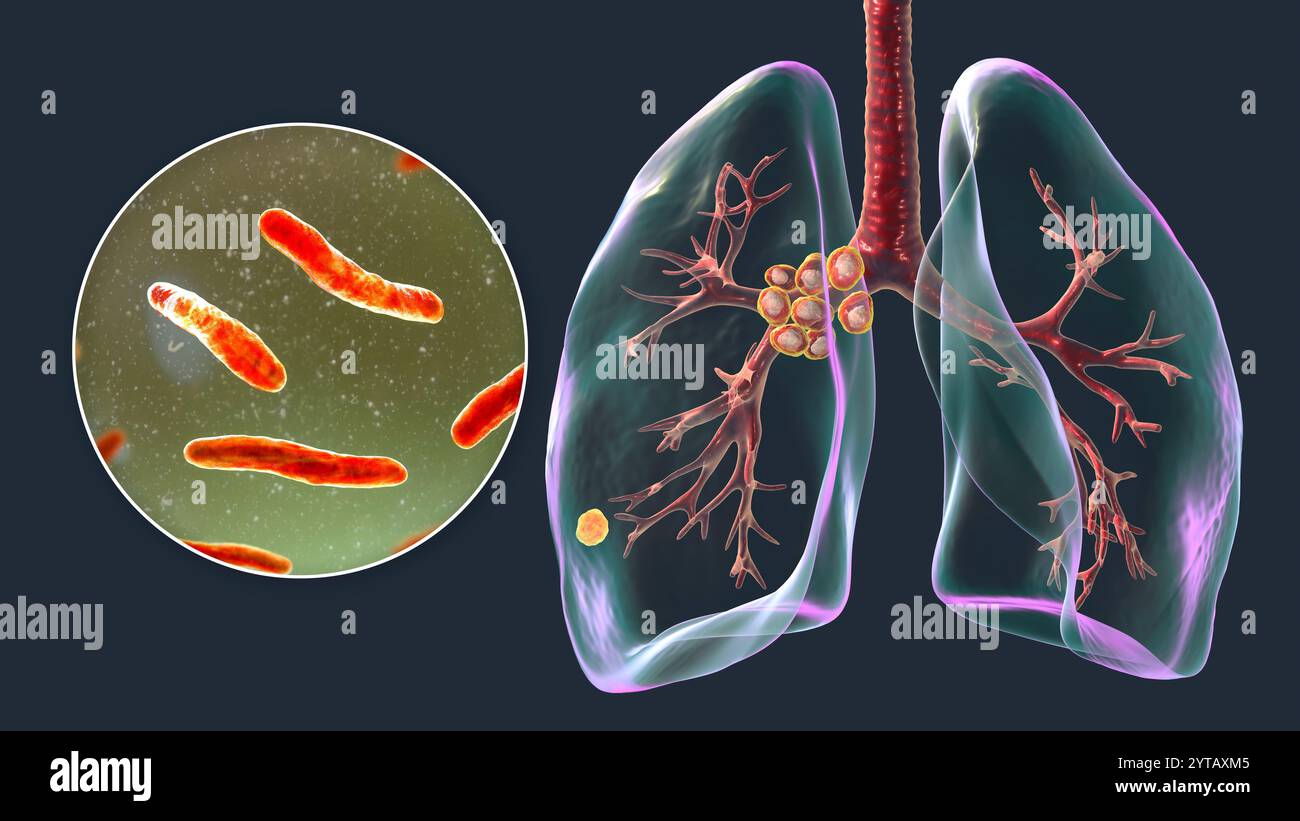 Primary lung tuberculosis with the Ranke complex. Computer illustration ...
