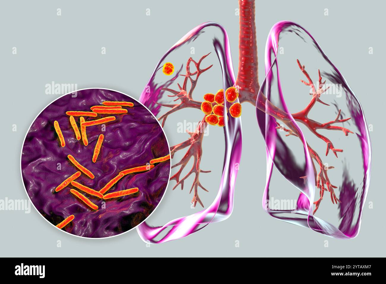 Primary lung tuberculosis. Computer illustration featuring the Ghon ...
