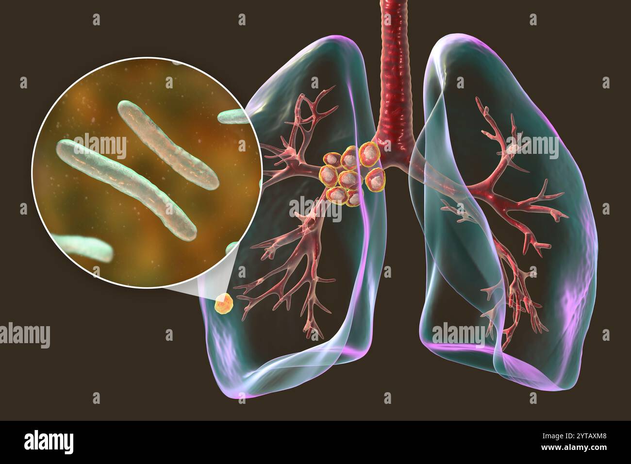 Primary lung tuberculosis with the Ranke complex. Computer illustration ...