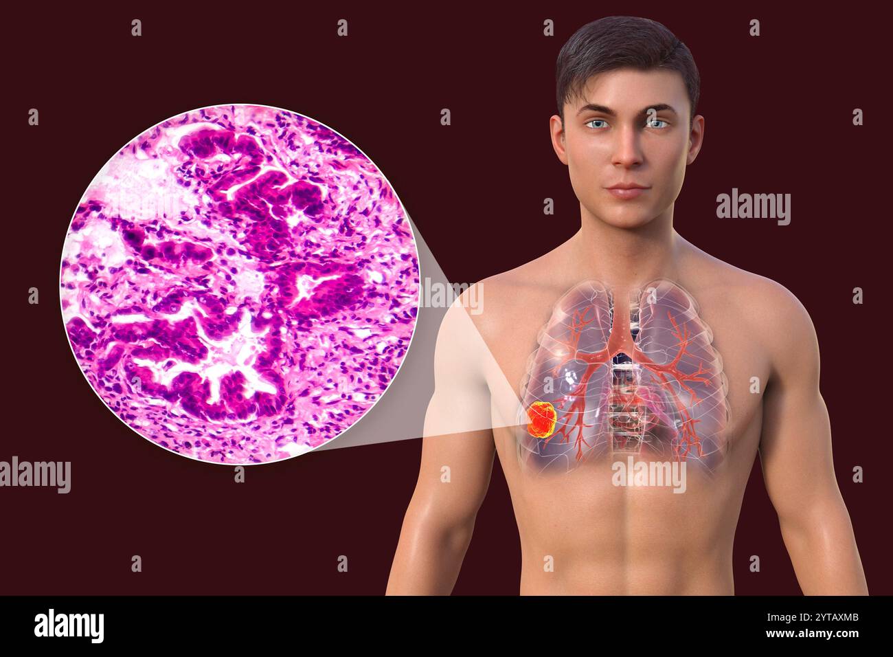 Computer illustration of a man with lung cancer, along with a light ...