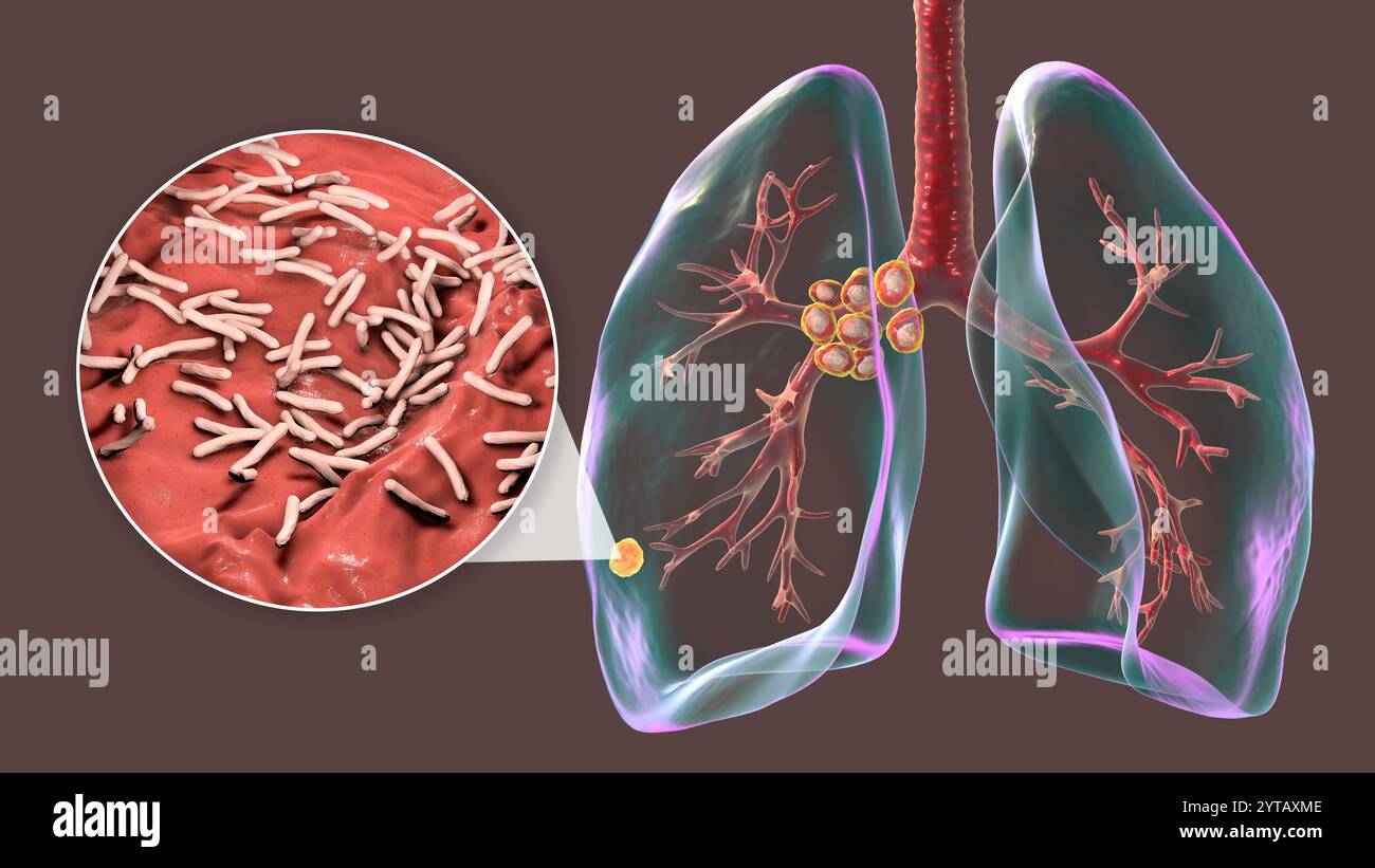 Primary lung tuberculosis with the Ranke complex. Computer illustration ...
