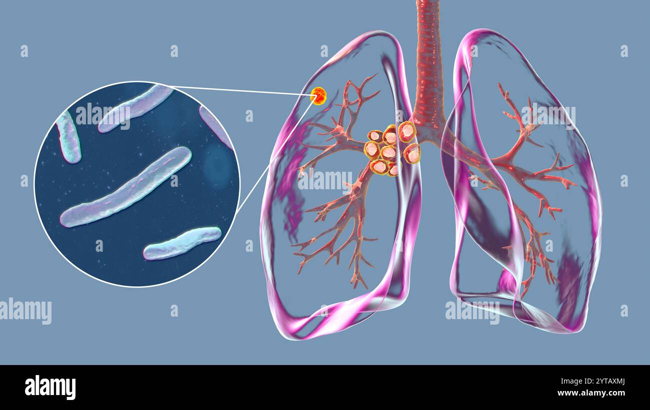 Primary lung tuberculosis with the Ranke complex. Computer illustration ...