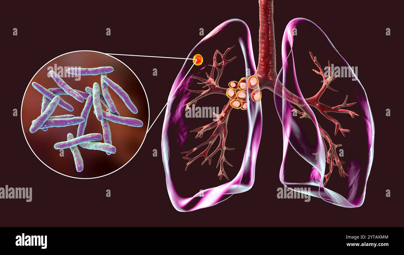 Primary lung tuberculosis with the Ranke complex. Computer illustration ...