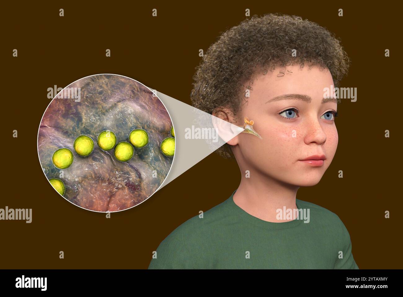 Computer illustration of a child with transparent skin revealing otitis ...
