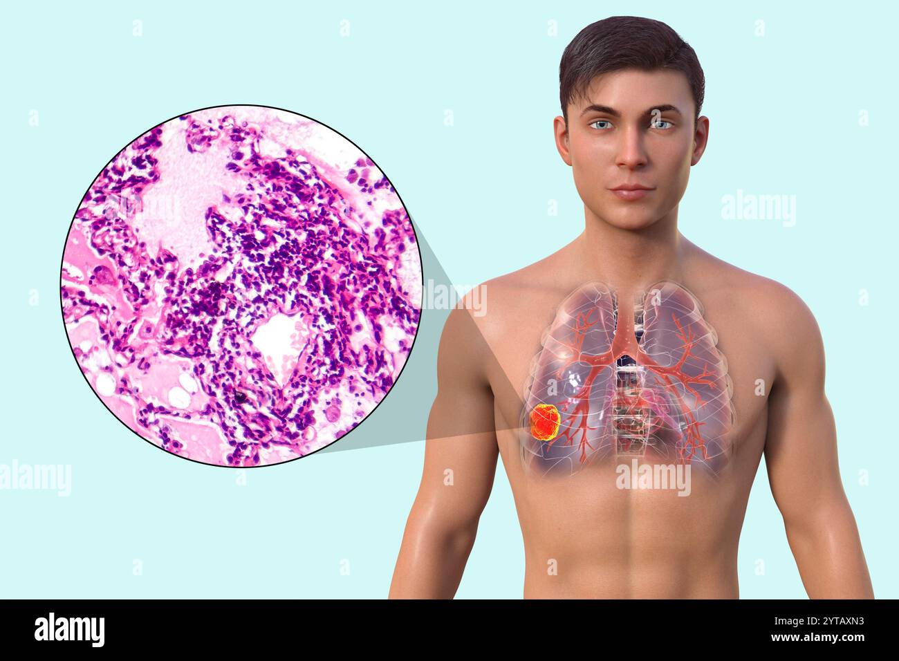 Computer illustration of a man with lung cancer, along with a light ...