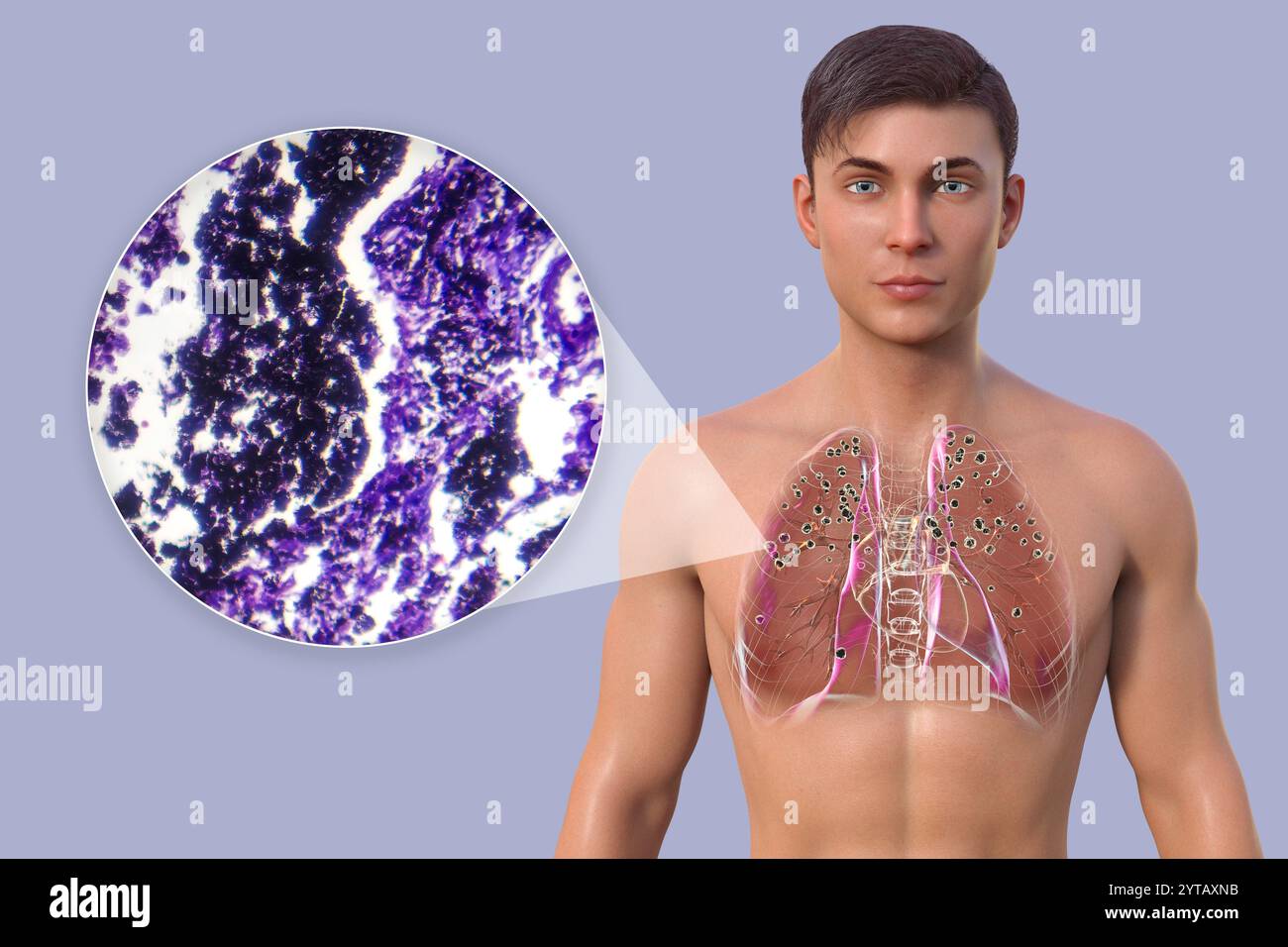 Computer illustration and light micrograph of a man with lungs affected ...