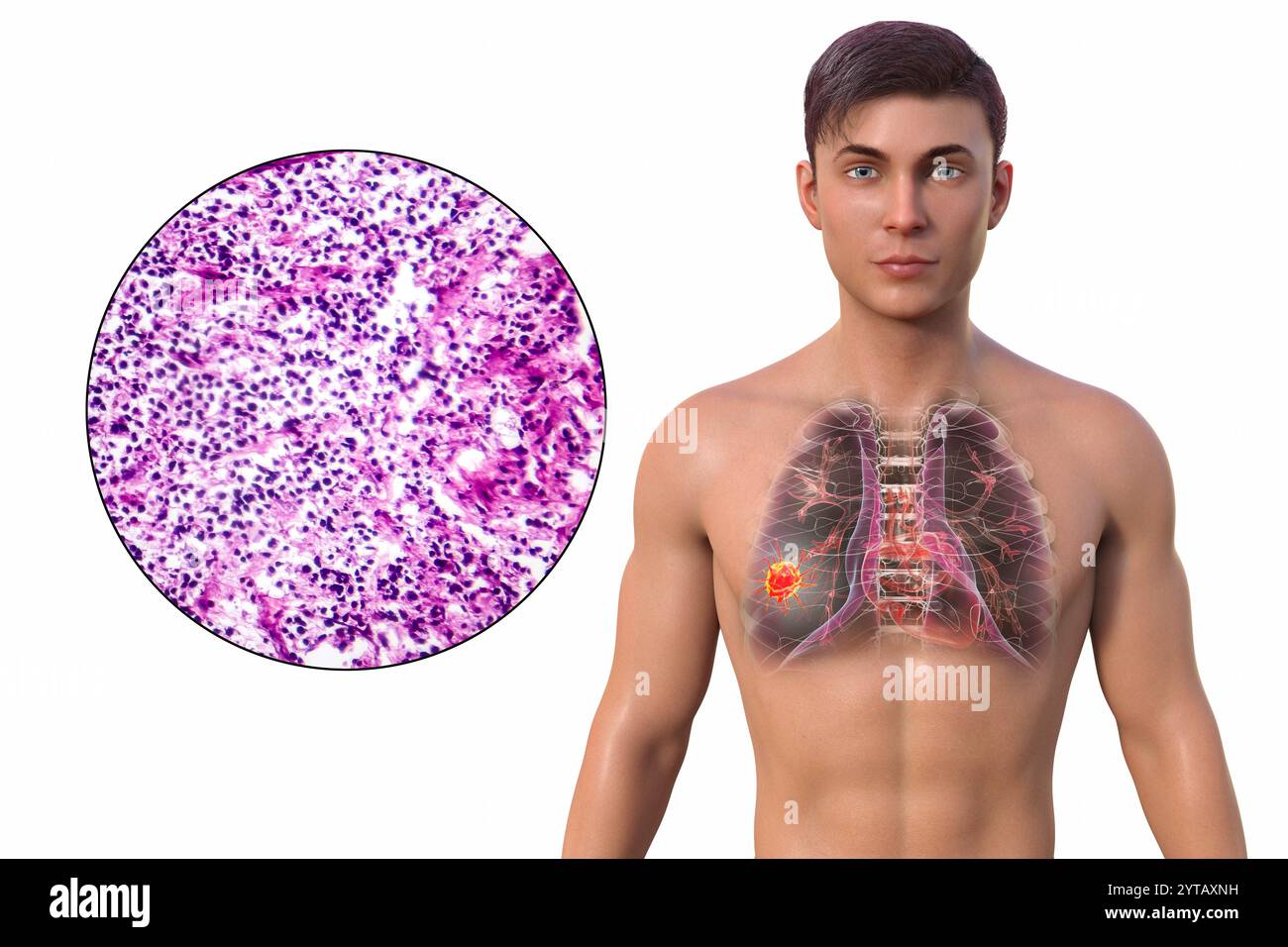 Computer illustration of a man with lung cancer, along with a light ...