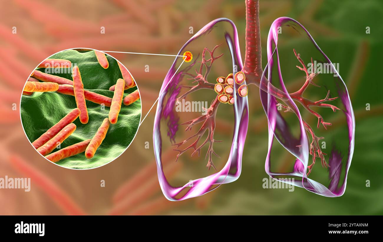 Primary lung tuberculosis with the Ranke complex. Computer illustration ...