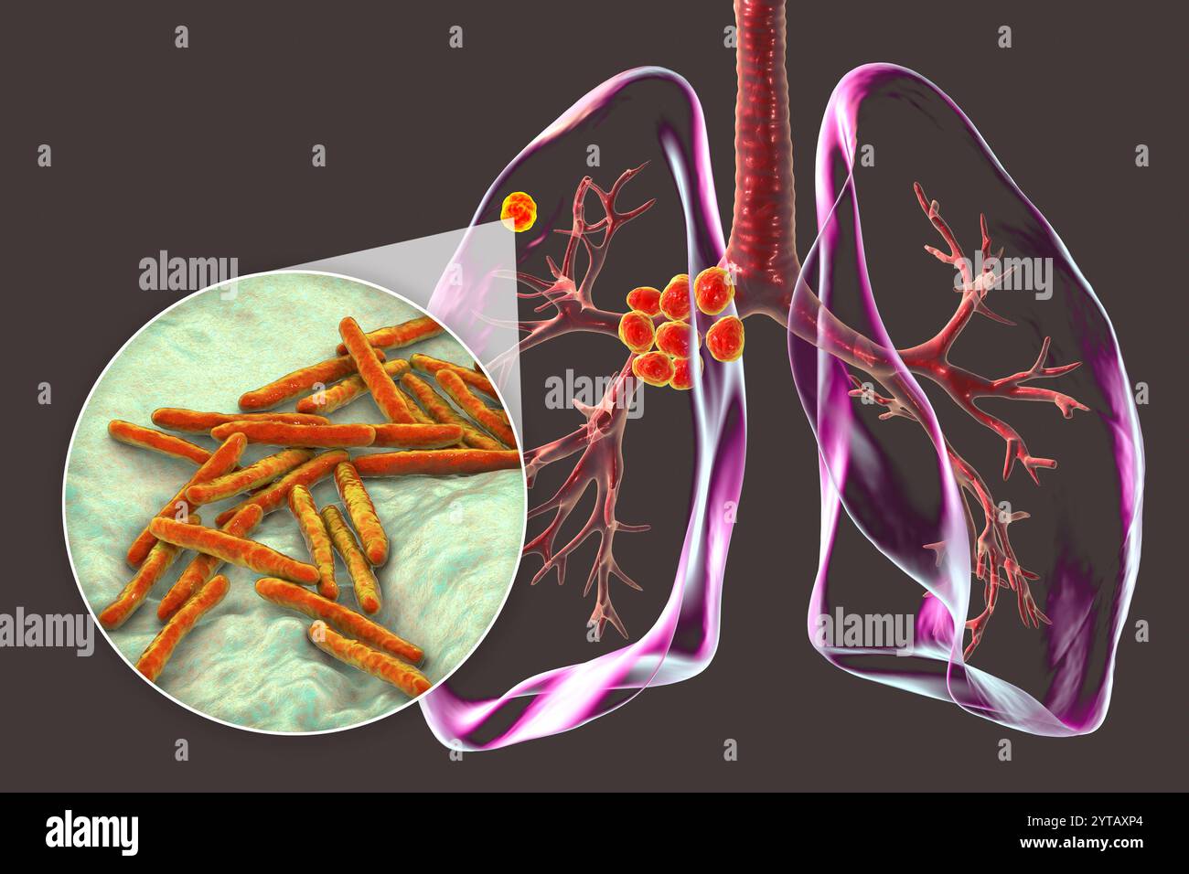 Primary lung tuberculosis. Computer illustration featuring the Ghon ...