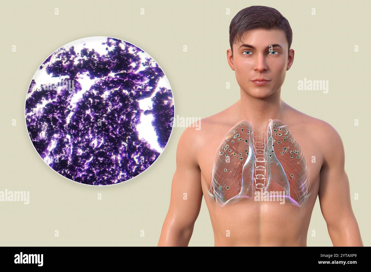 Computer illustration and light micrograph of a man with lungs affected ...
