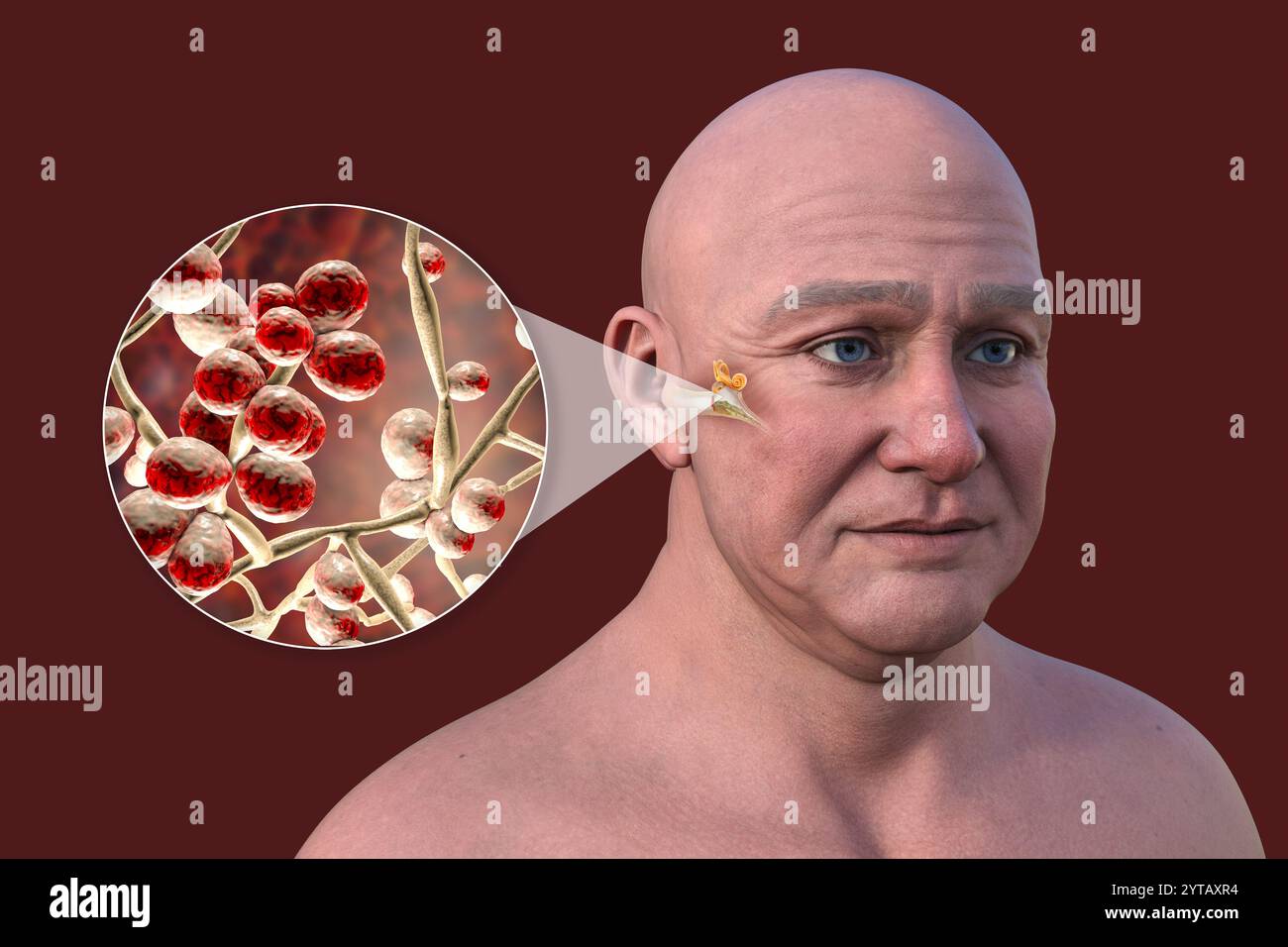 Computer illustration of a man with transparent skin depicting fungal ...