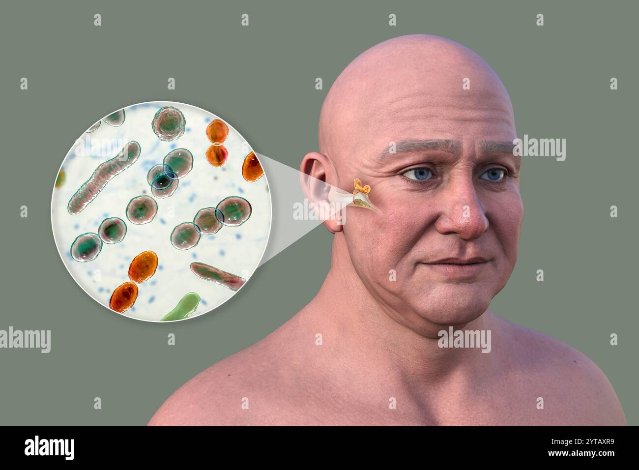 Computer illustration of a man with transparent skin revealing otitis ...